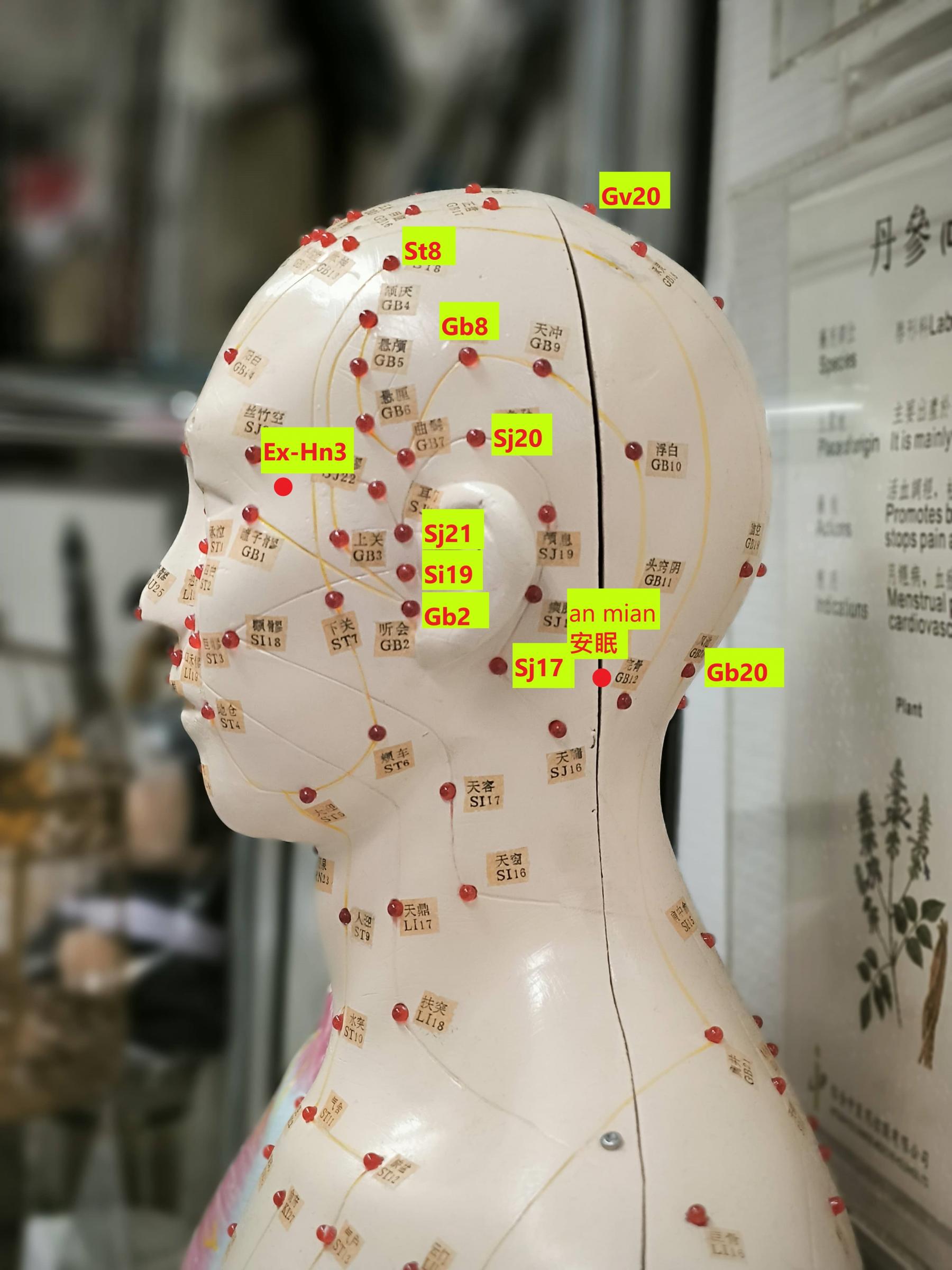 Chinese Acupuncture Therapy for Ear Ringing (Tinnitus)