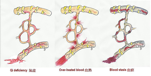 TCM Views on Development of Bleeding