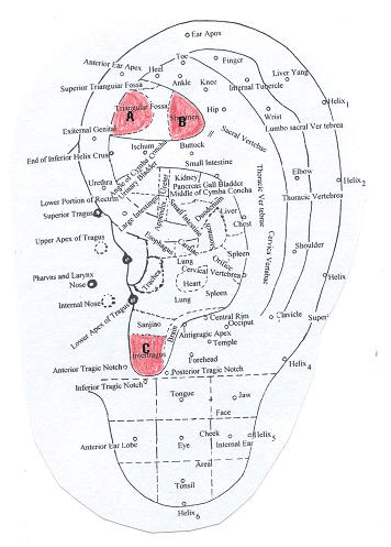 Auricular Therapy for Premenstrual Syndrome (PMS)